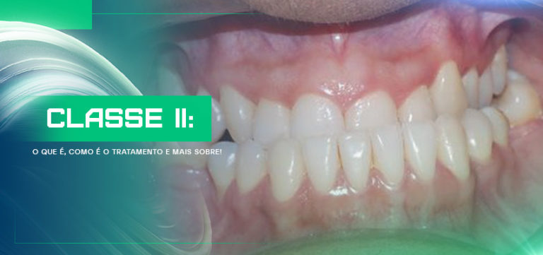 Classe II: o que é, como é o tratamento e mais sobre!