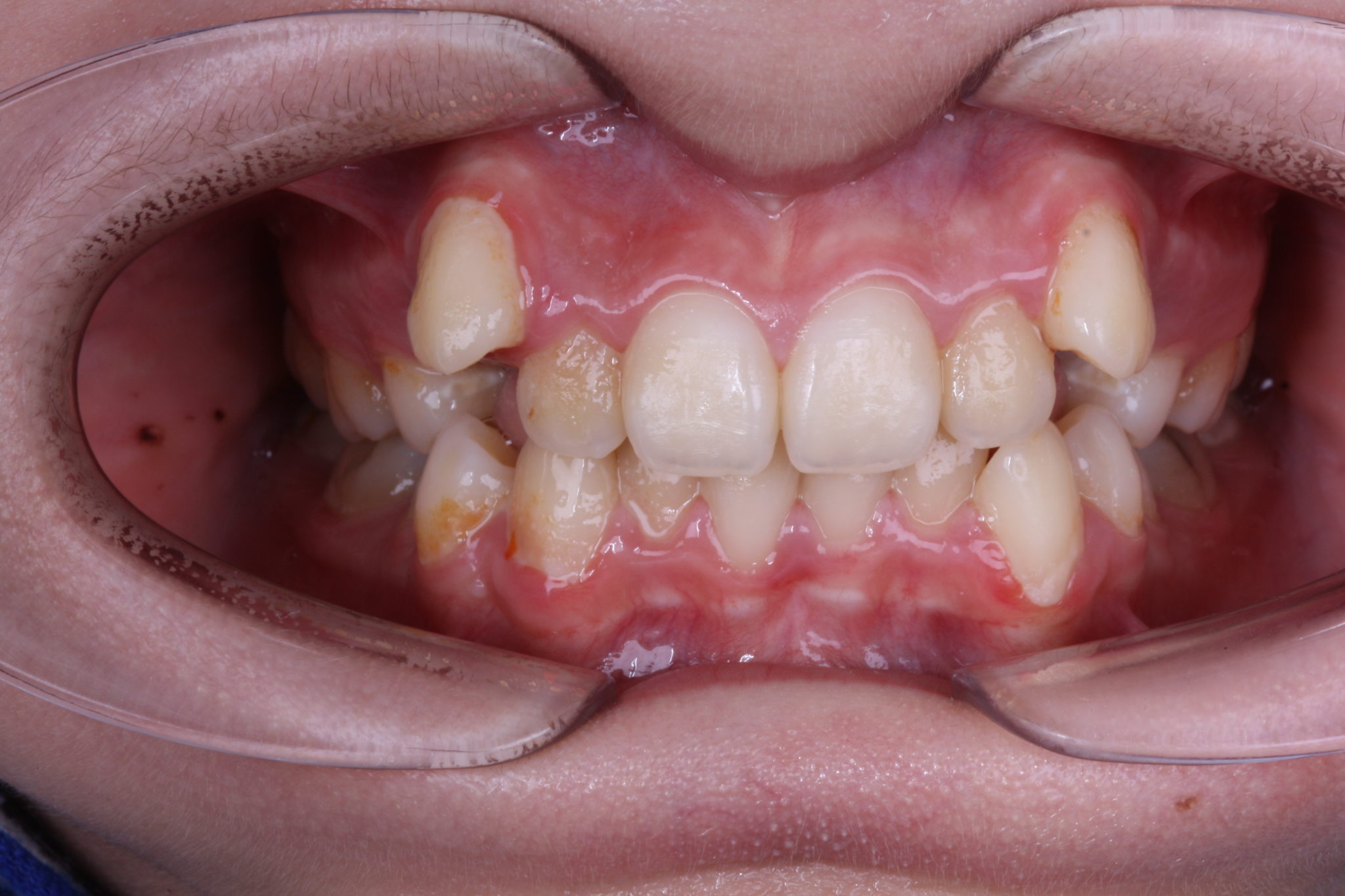 Severe crowding and a full class II molar relationship treated with ...