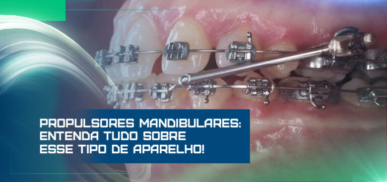 Propulsores Mandibulares: entenda tudo sobre esse tipo de aparelho!