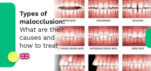 Types of occlusion: what they are, their causes and how to treat