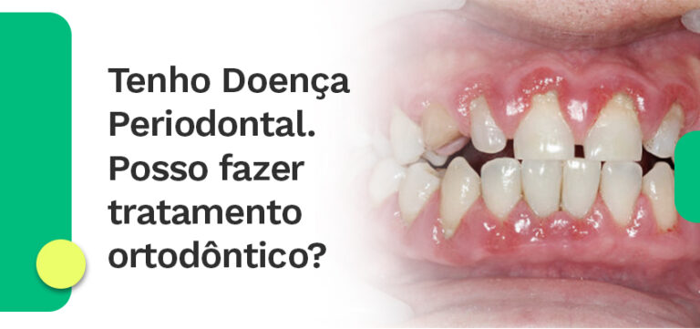 Tenho Doença Periodontal. Posso fazer tratamento ortodôntico? | Aditek