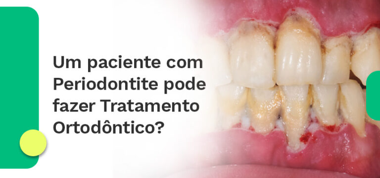 Um paciente com Periodontite pode fazer Tratamento Ortodôntico? | Aditek