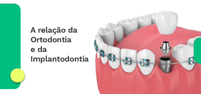 A relação da Ortodontia e da Implantodontia | Aditek